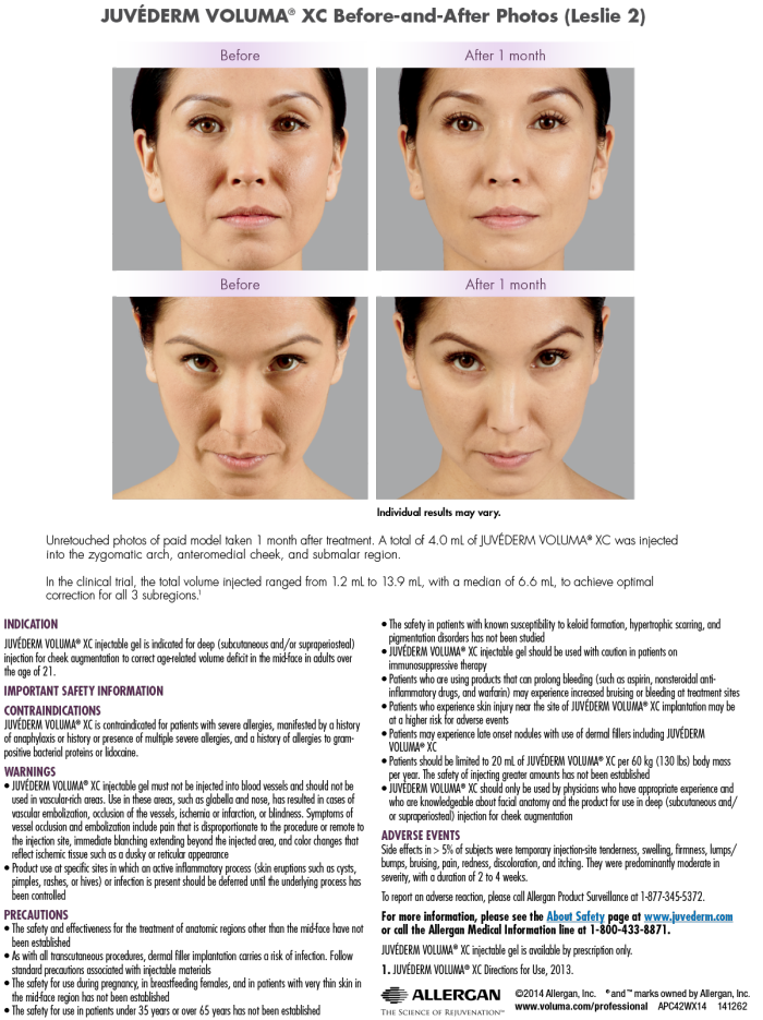 Juvederm Voluma XC - Meirson Dermatology